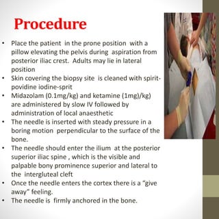 Bone marrow aspiration,by Dr Sahana Shankari, Senior Resident ...