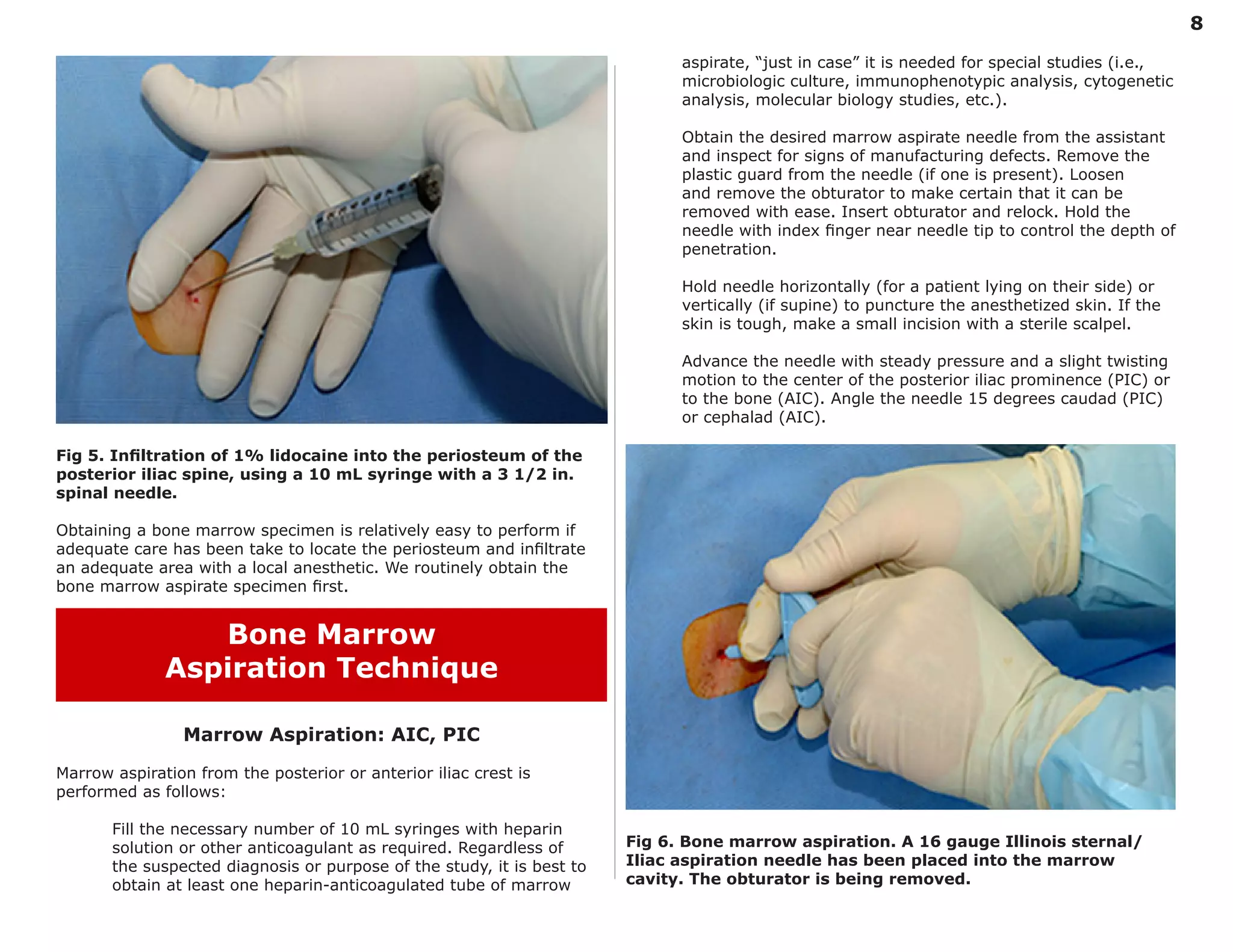 Bone marrow aspiration technique.pdf