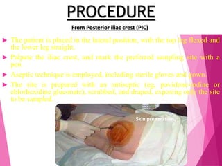 Posterior Iliac Crest Bone Marrow Biopsy