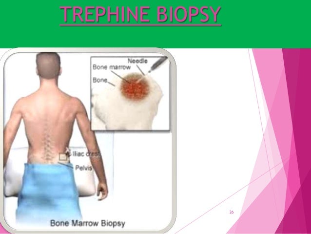 Bone marrow aspiration & trephine biopsy