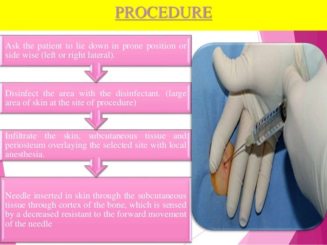 Bone Marrow Aspiration Trephine Biopsy Bone Marrow Aspiration Trephine Biopsy