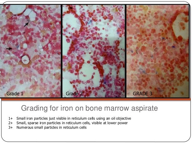 Bone marrow biopsy