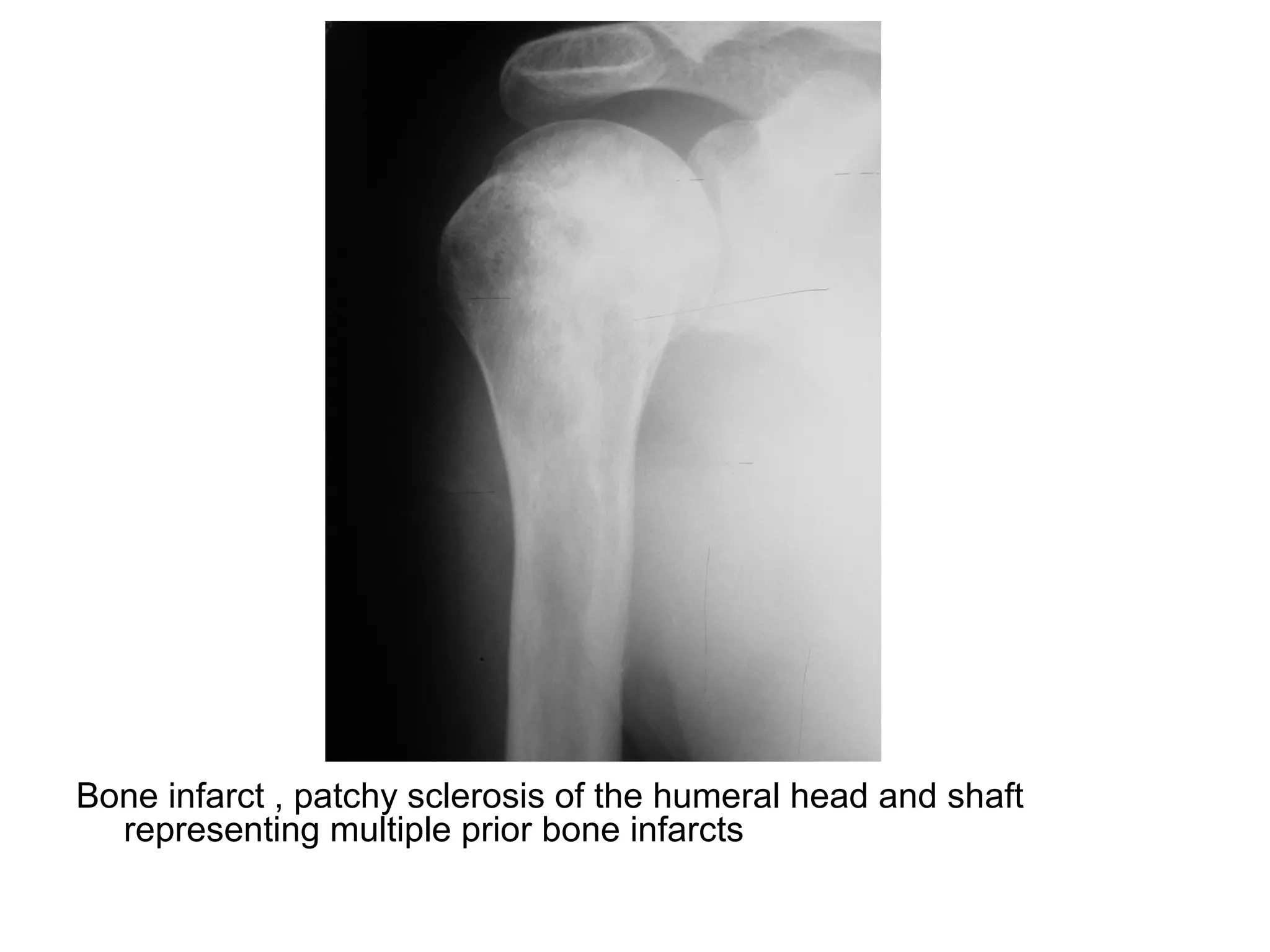 Diagnositc Imaging of Bone Marrow Disease | PPT