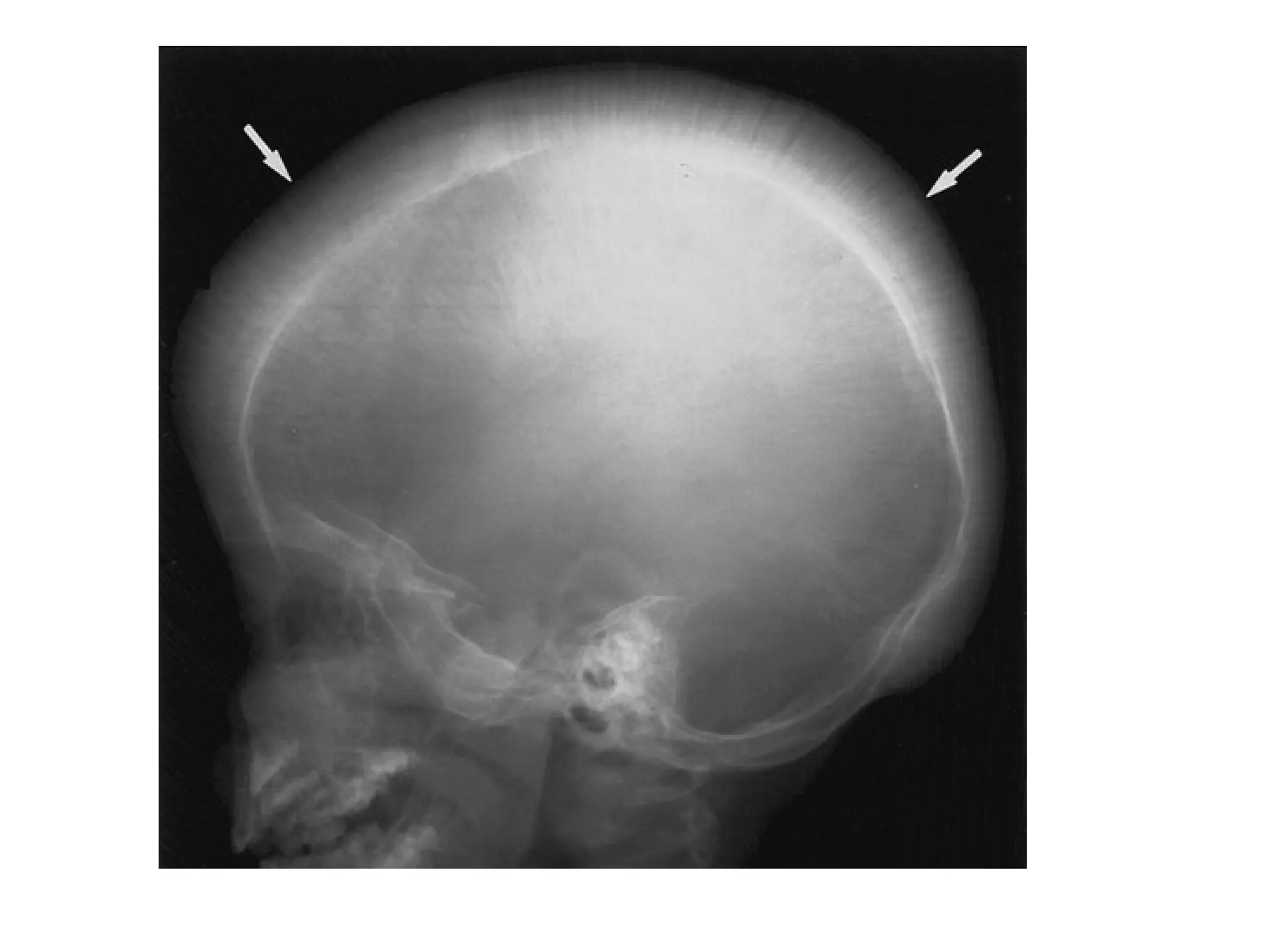 Diagnositc Imaging of Bone Marrow Disease | PPT