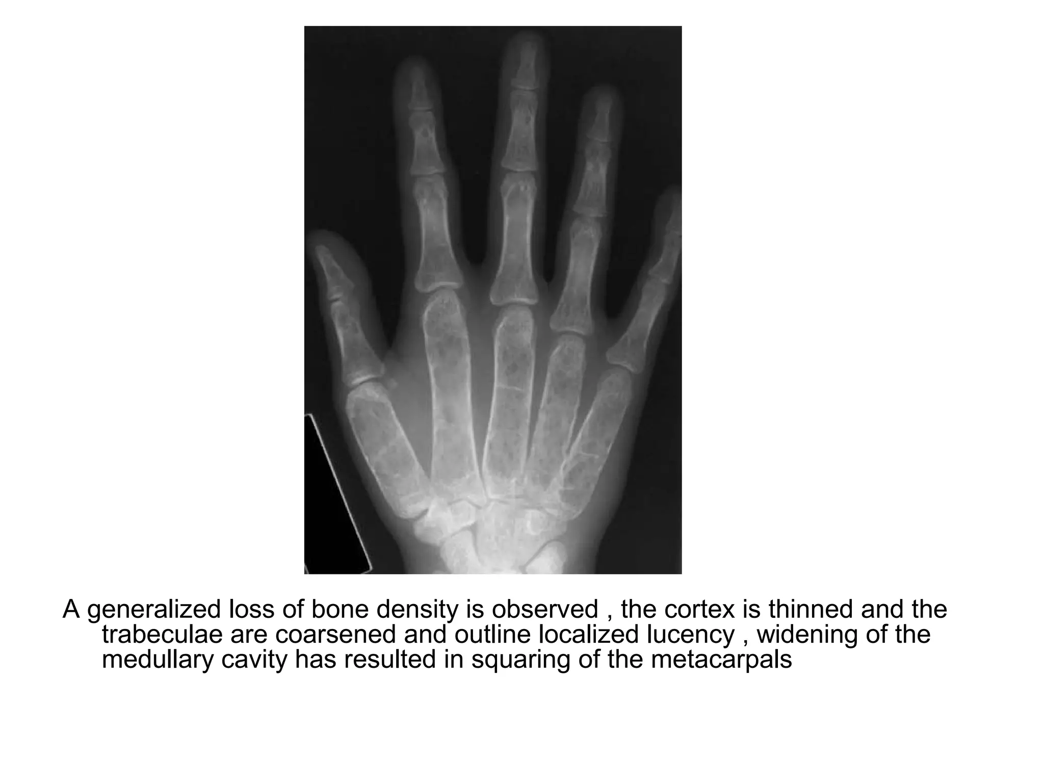 Diagnositc Imaging of Bone Marrow Disease | PPT