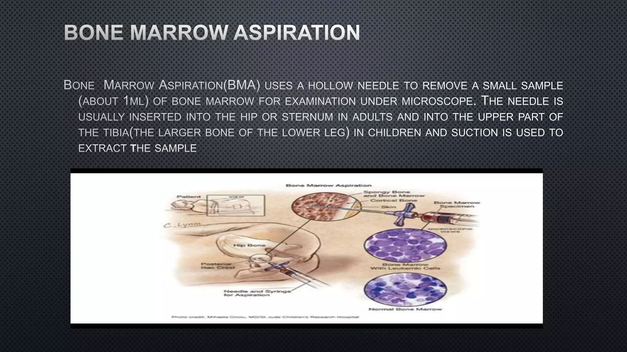 Bone marrow disorders yashoda hospitals-susheel morris.ppt