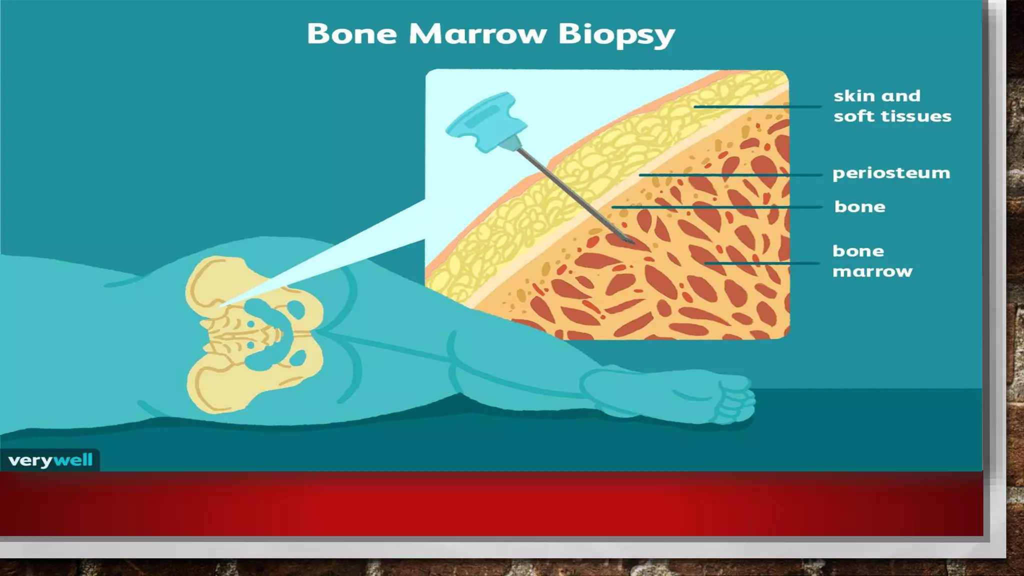 Bone marrow examination | PPTX