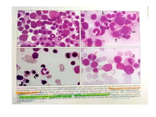 BONE MARROW EXAMINATION presentation for pathology | PPTX