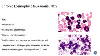 BONE MARROW IN LEUKEMIAS.types of leukaemia | PPTX