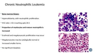 BONE MARROW IN LEUKEMIAS.pptx types of leukemia | PPTX