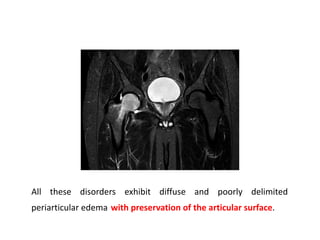 BONE MARROW LESIONS IN KNEE JOINT I DR.RAJAT JANGIR ORTHOPAEDIC DOCTOR ...