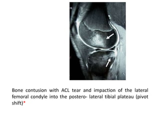BONE MARROW LESIONS IN KNEE JOINT I DR.RAJAT JANGIR ORTHOPAEDIC DOCTOR ...