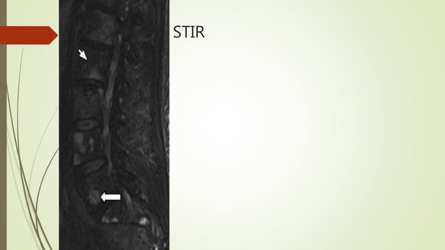 Bone marrow signal change | PPTX | Blood Disorders | Diseases and ...