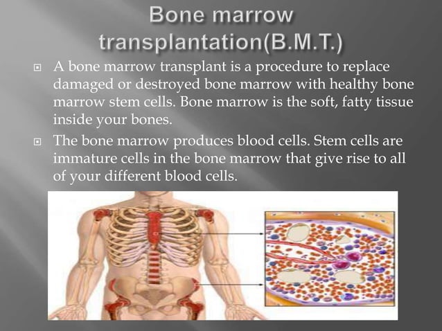 Bone marrow transplantation | PPTX