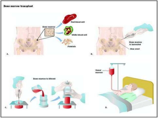 Bone marrow transplantation | PPTX | Blood Disorders | Diseases and ...