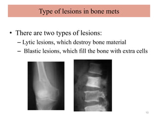 Bone metastasis | PPT