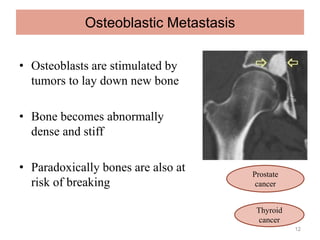 Bone metastasis | PPT