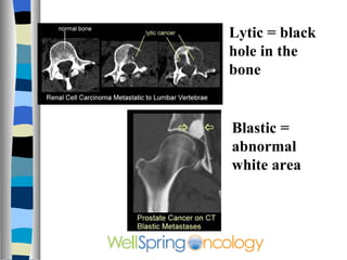 Bone Metastases | PPT