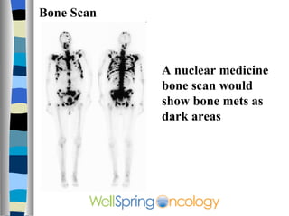 Bone Metastases | PPT