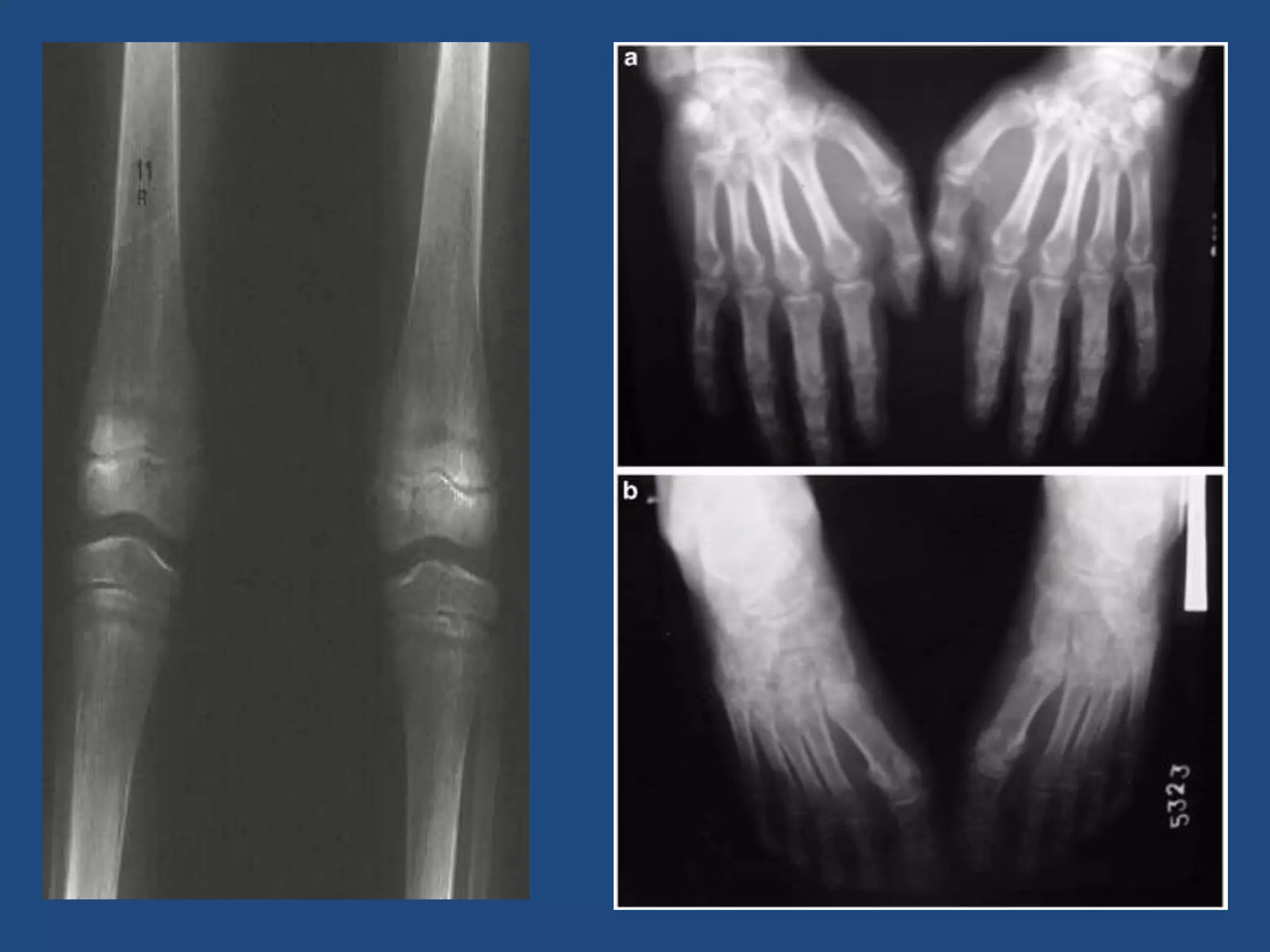 Bone mineral density (bmd) test | PPTX