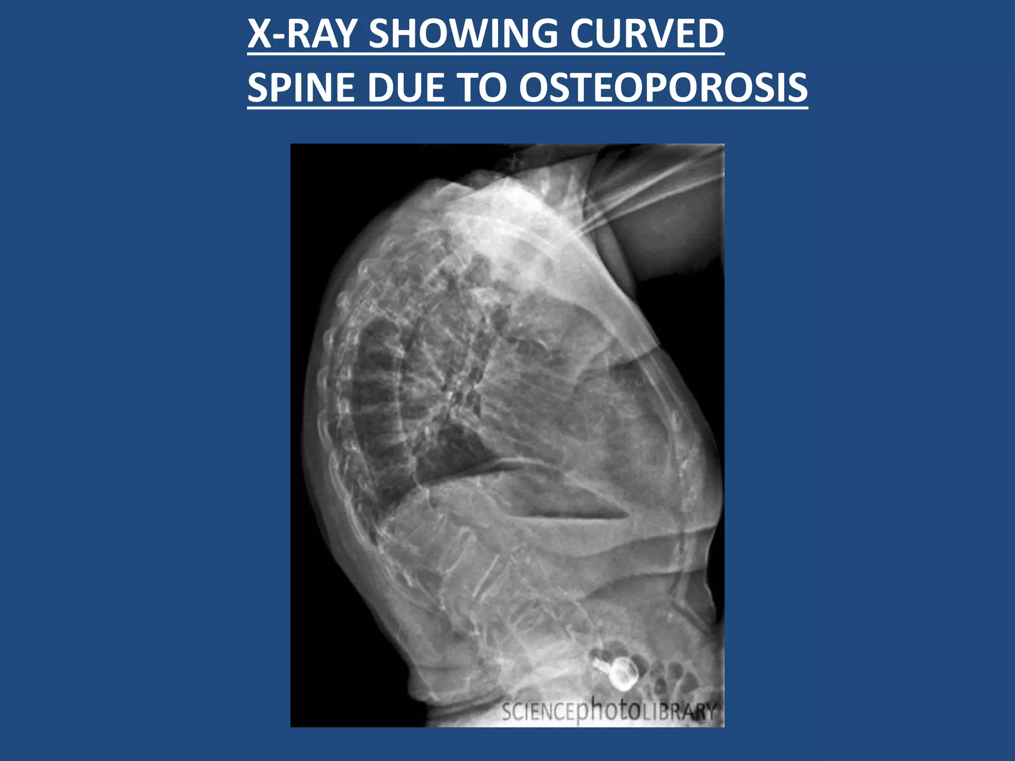 Bone mineral density (bmd) test | PPTX | Bone and Joint Conditions ...
