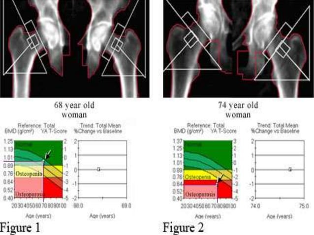 Bone mineral density (bmd) test | PPTX | Bone and Joint Conditions ...
