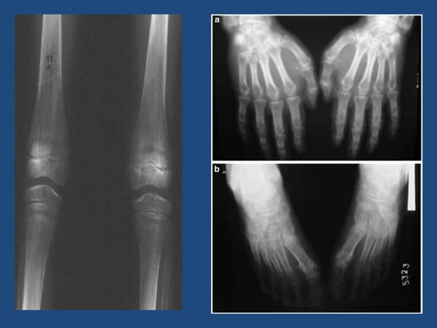 Bone mineral density (bmd) test | PPTX | Bone and Joint Conditions ...