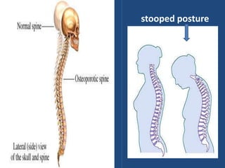 Bone mineral density (bmd) test | PPTX
