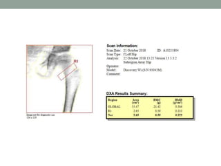 Bone mineral density in children | PPTX