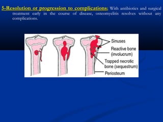 osteomylitis | PPT