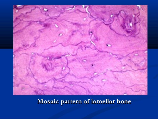 osteomylitis