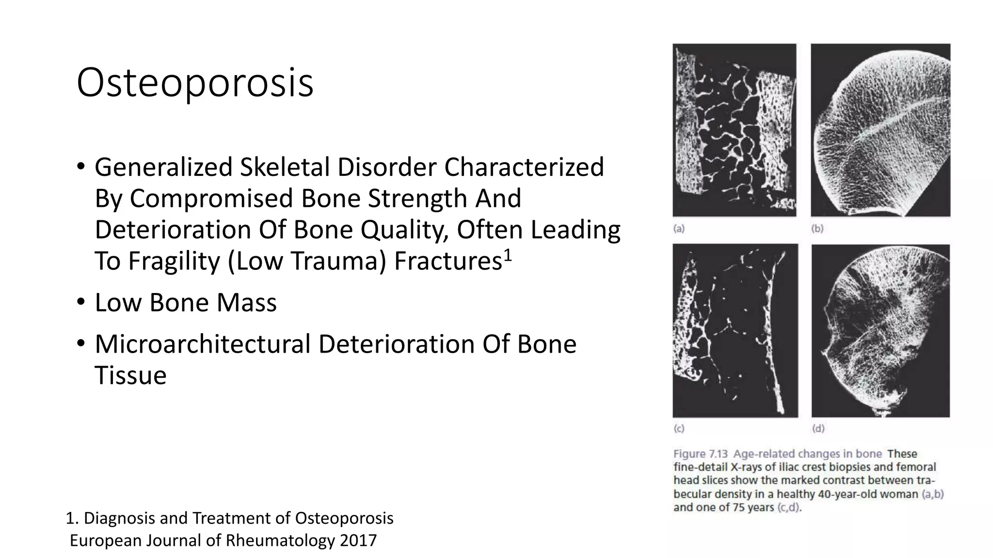 Bone physiology, OSTEOPOROSIS, Pagets Disease, Hyperparathyoidism | PPTX