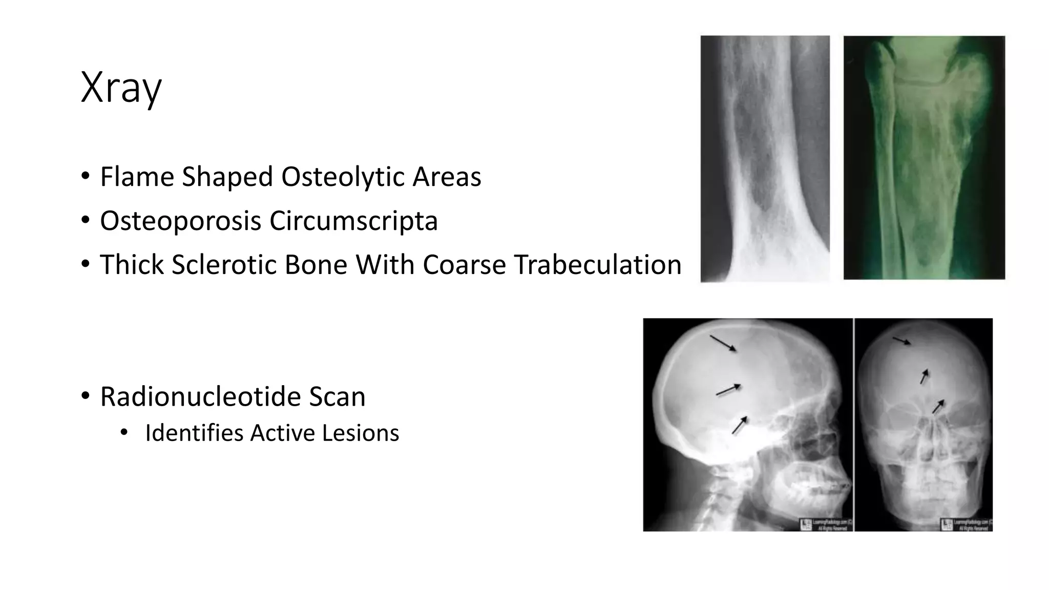 Bone physiology, OSTEOPOROSIS, Pagets Disease, Hyperparathyoidism | PPTX