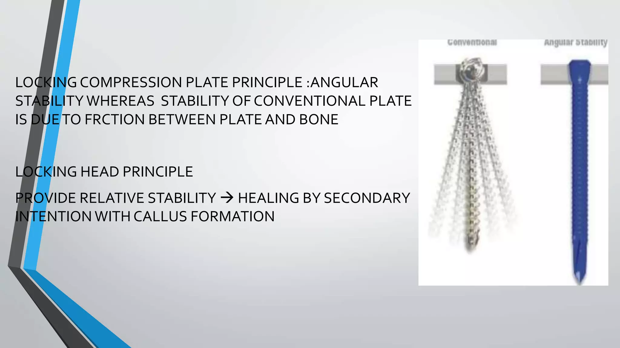 ORTHOPEDIC BONE PLATE | PPTX