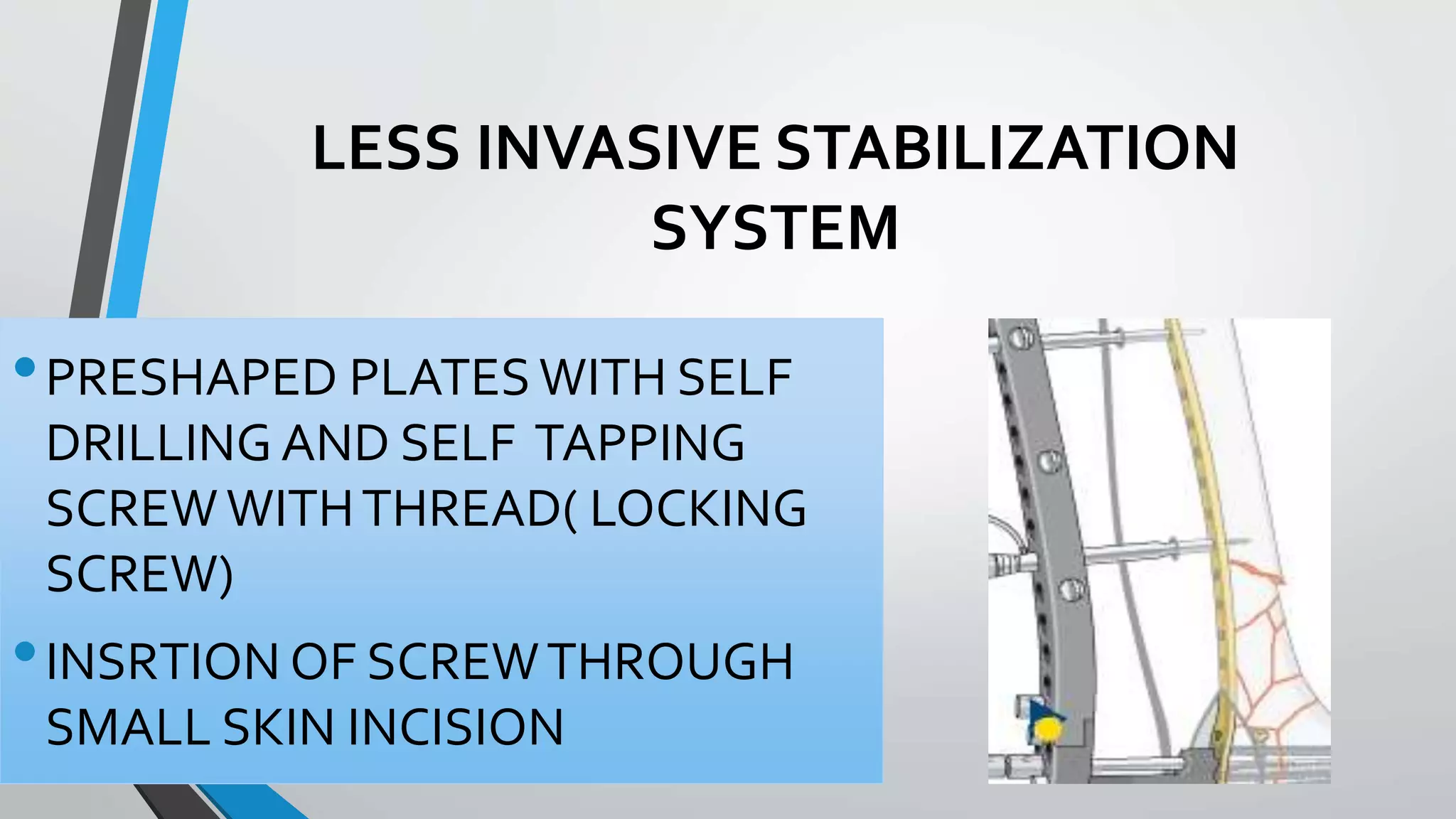 ORTHOPEDIC BONE PLATE | PPTX