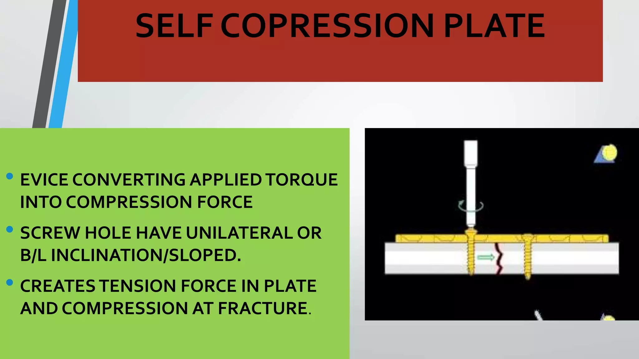 ORTHOPEDIC BONE PLATE | PPTX