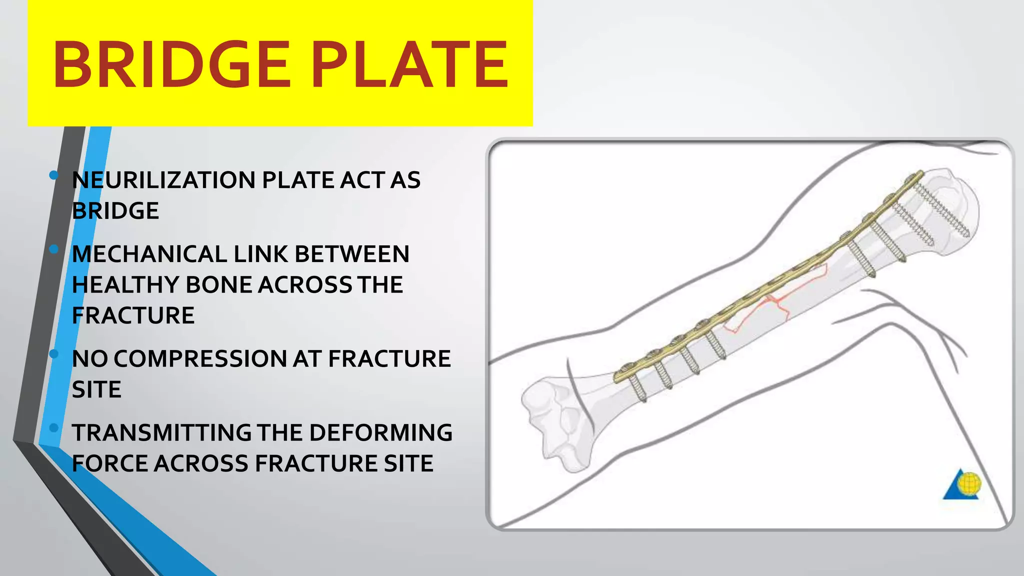 ORTHOPEDIC BONE PLATE | PPTX