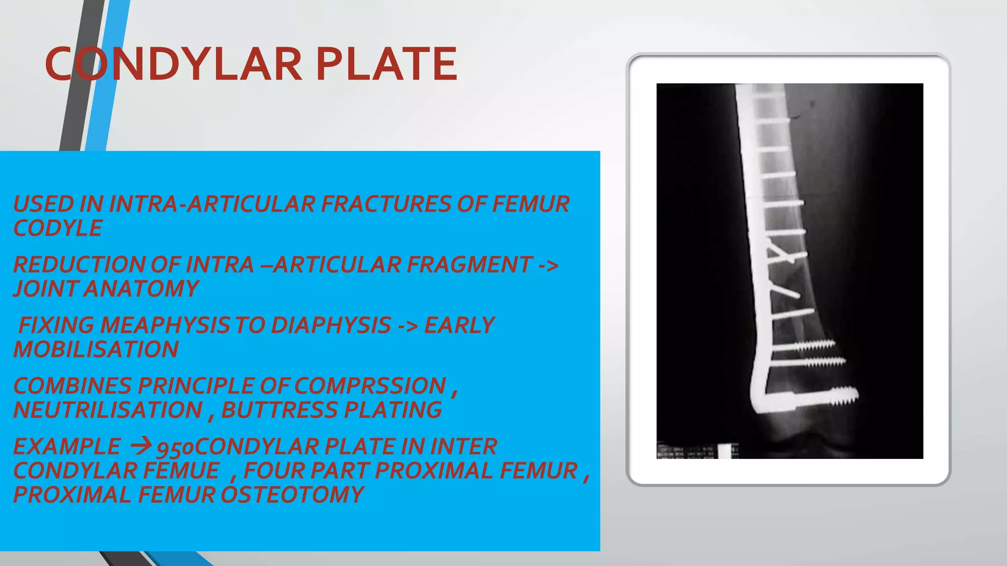 ORTHOPEDIC BONE PLATE | PPTX
