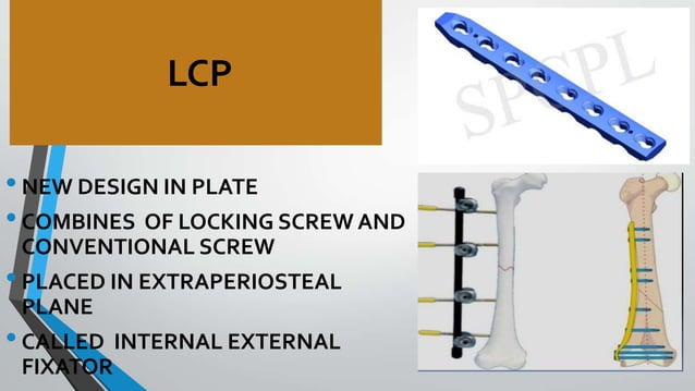 ORTHOPEDIC BONE PLATE | PPTX