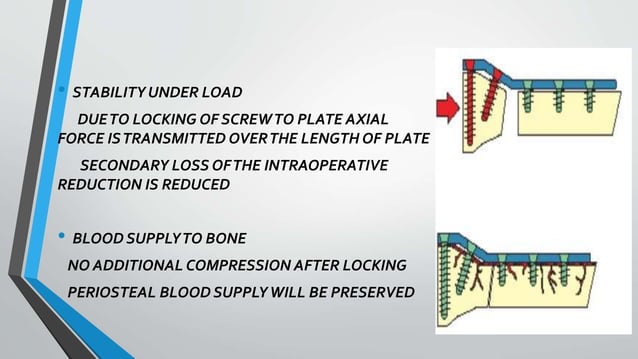 ORTHOPEDIC BONE PLATE | PPTX