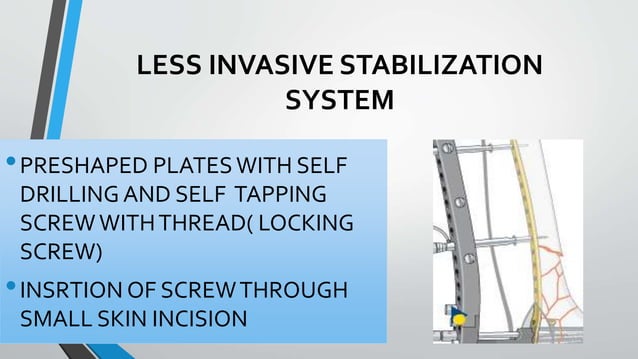ORTHOPEDIC BONE PLATE | PPTX