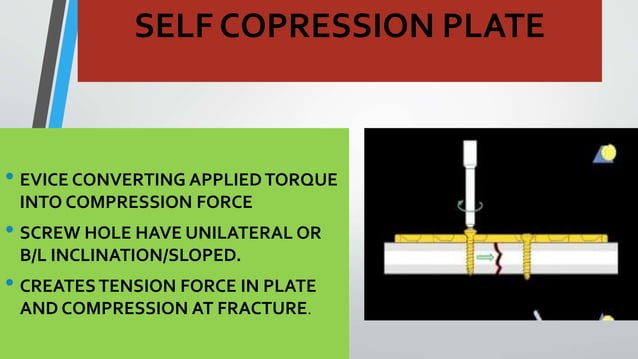 ORTHOPEDIC BONE PLATE | PPTX