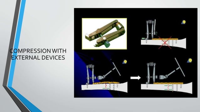 ORTHOPEDIC BONE PLATE | PPTX