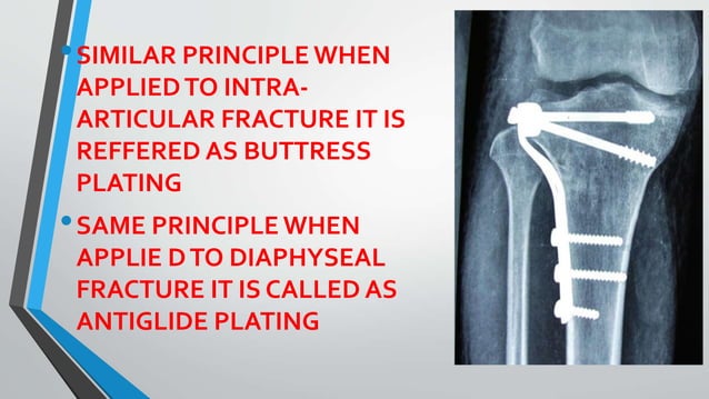 ORTHOPEDIC BONE PLATE | PPTX