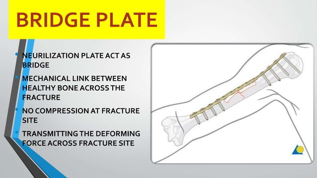 ORTHOPEDIC BONE PLATE | PPTX