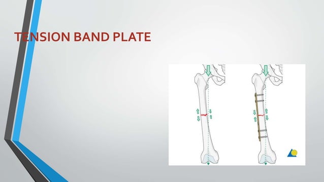 ORTHOPEDIC BONE PLATE | PPTX