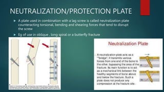 BONE PLATES final.pptx
