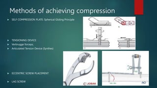 BONE PLATES final.pptx