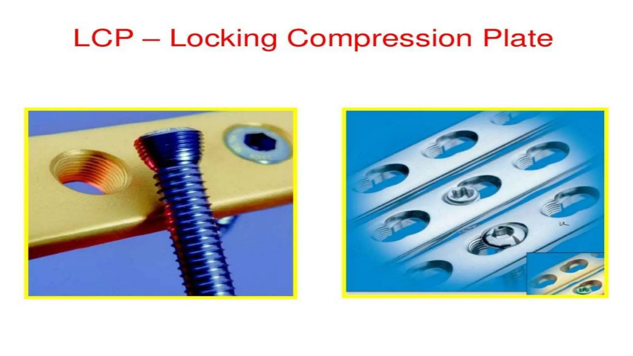BONE PLATING USES AND COMPLICATION ORTHOPAEDICS PPT | PPTX