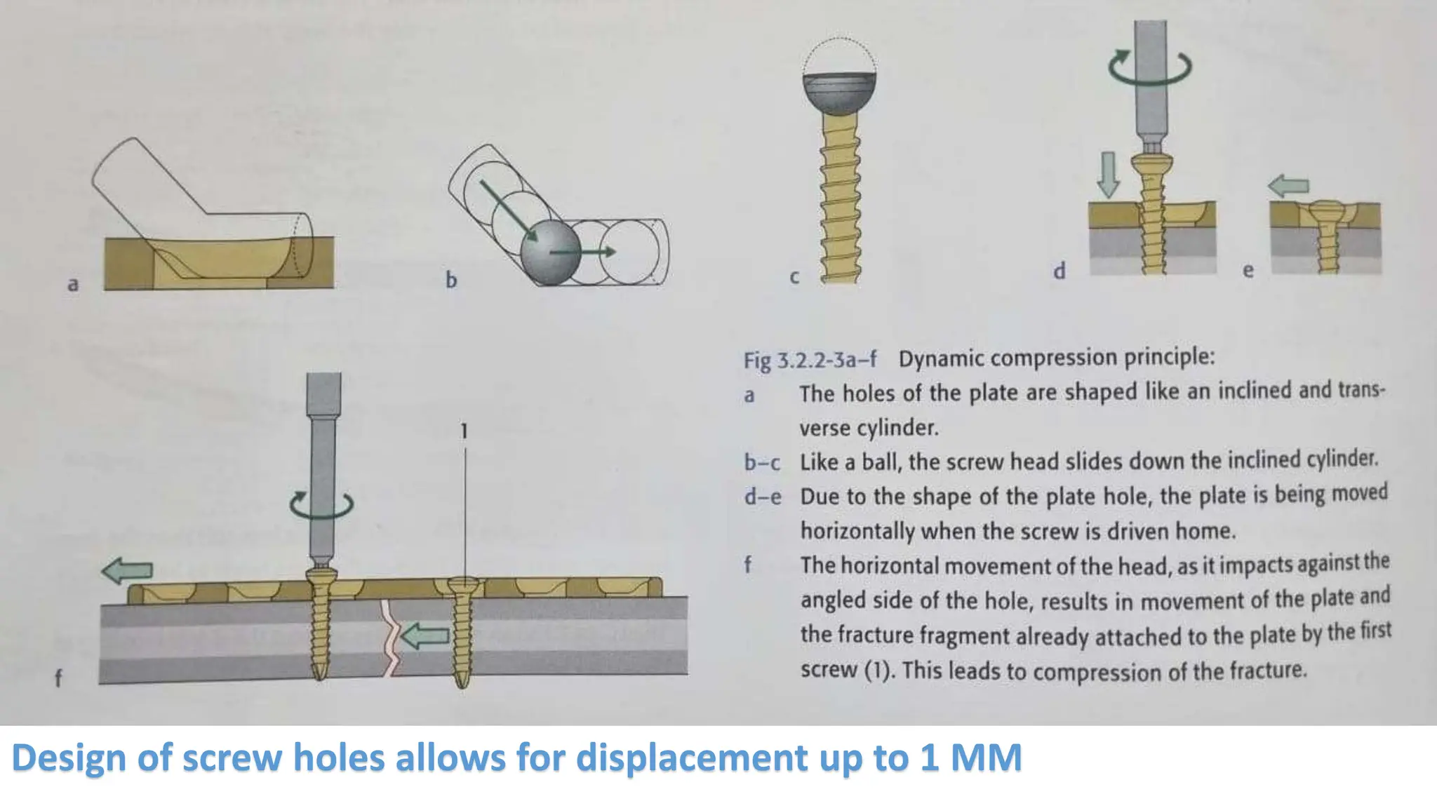 BONE PLATING USES AND COMPLICATION ORTHOPAEDICS PPT | PPTX
